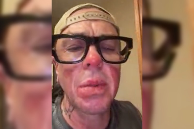Slipknot's Sid Wilson Says His 'Face is Melted' After Explosion