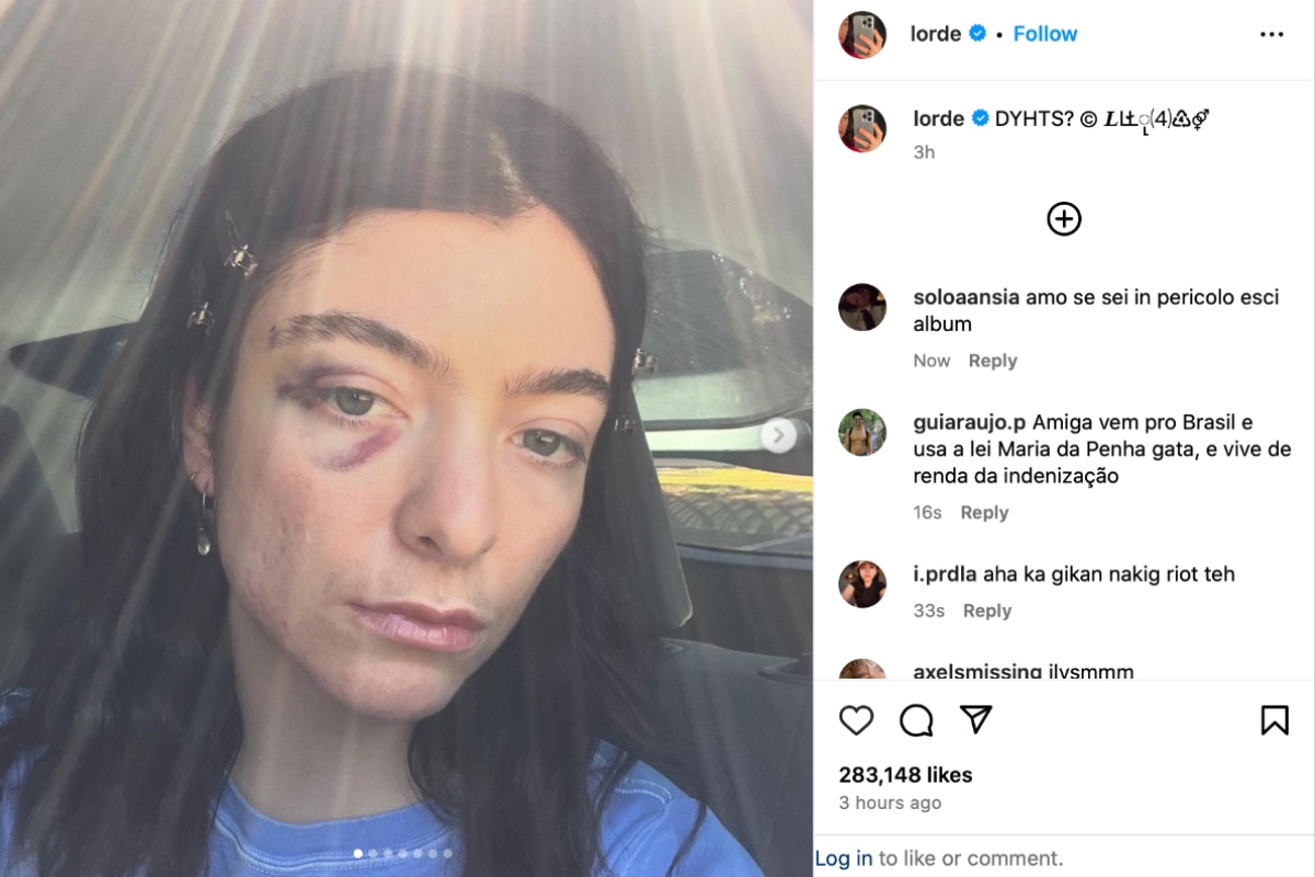 Singer Lorde Horrifies Fans With Nasty Black Eye in New Photos