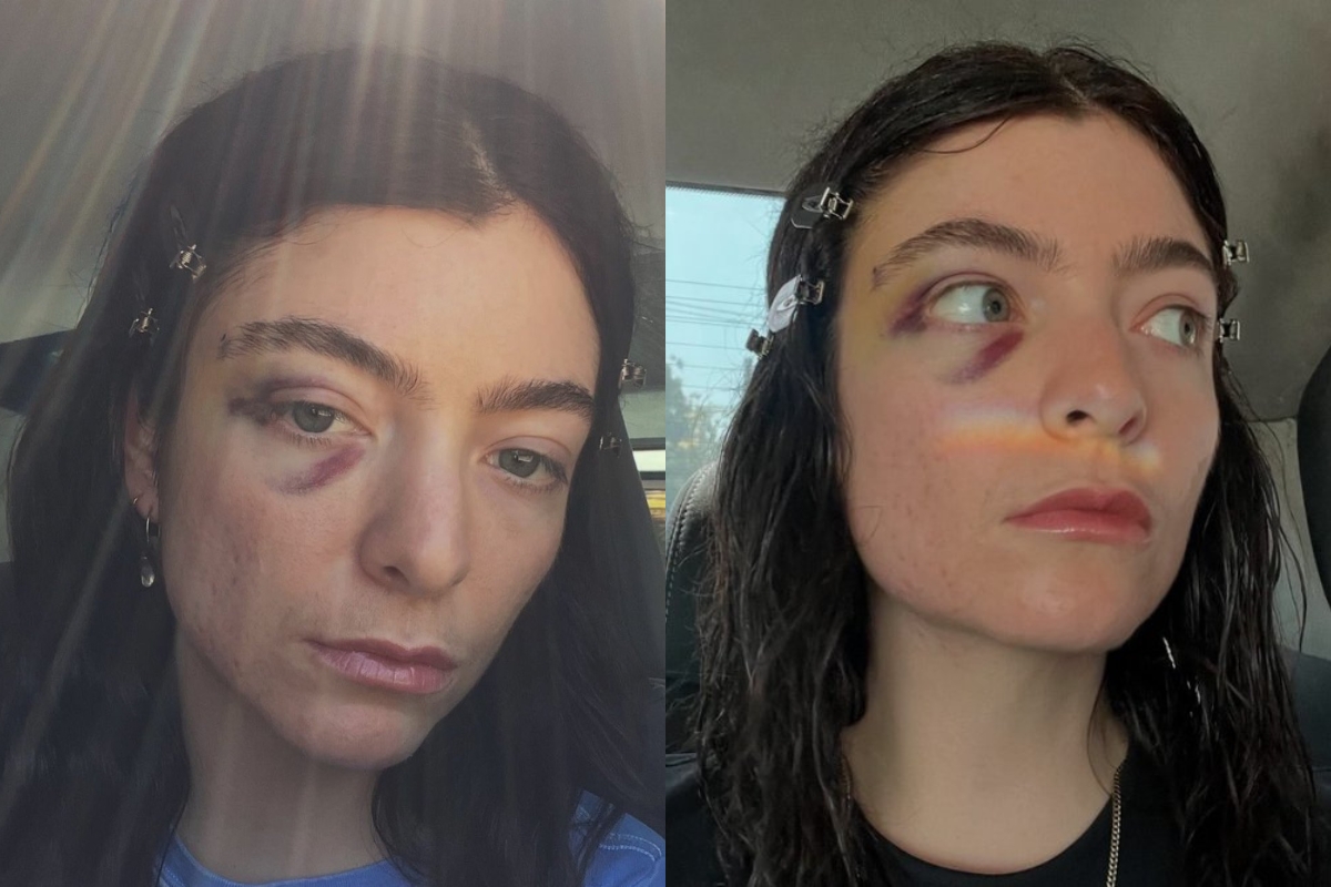 Singer Lorde Horrifies Fans With Nasty Black Eye in New Photos