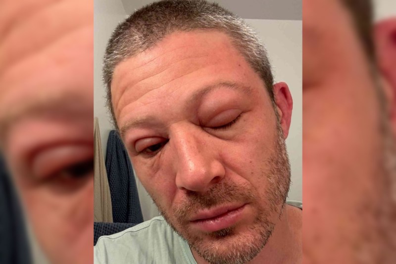 Zach Gilford Shares Shocking Photos of Swollen Face