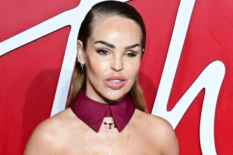 TV Presenter Says She’s Getting an Artificial Eye 17 Years After Acid ...