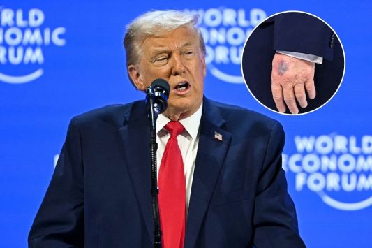 President Trump Responds to Questions About Noticeable Bruise on Left Hand